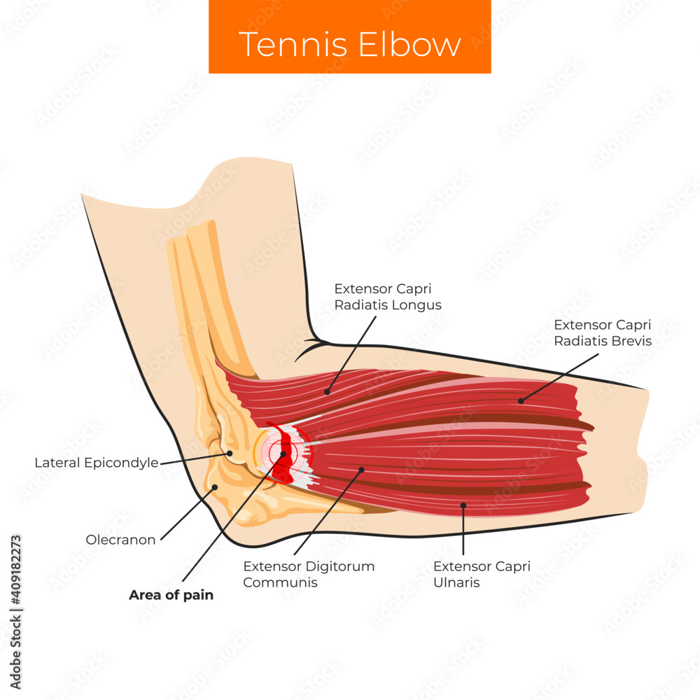 Vector illustration. Tennis Elbow Area of Pain. Elbow joint. Stock ...