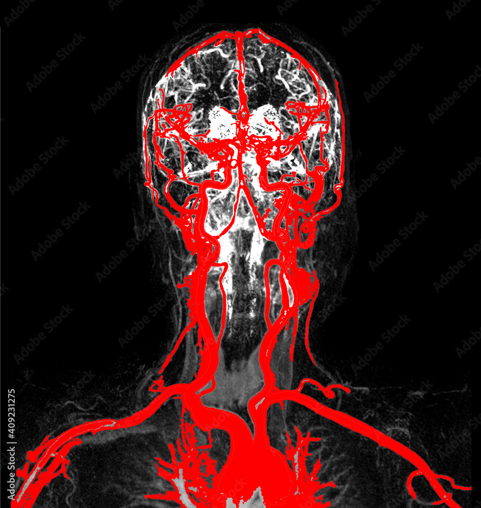 MRA (magnetic resonance angiography) of brain for stroke patient or ...