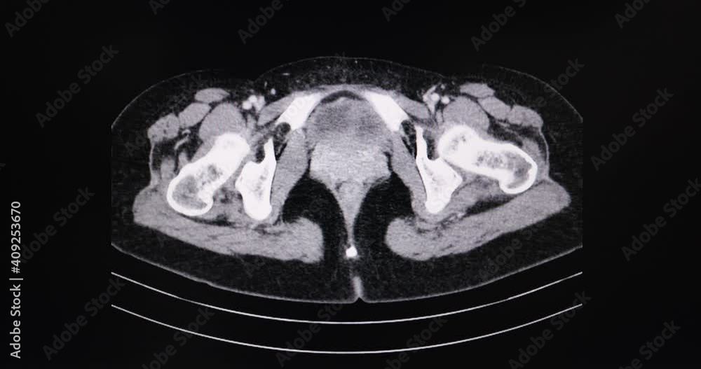 A motion CT scan of an abdomen of a female patient with carcinoma of ...