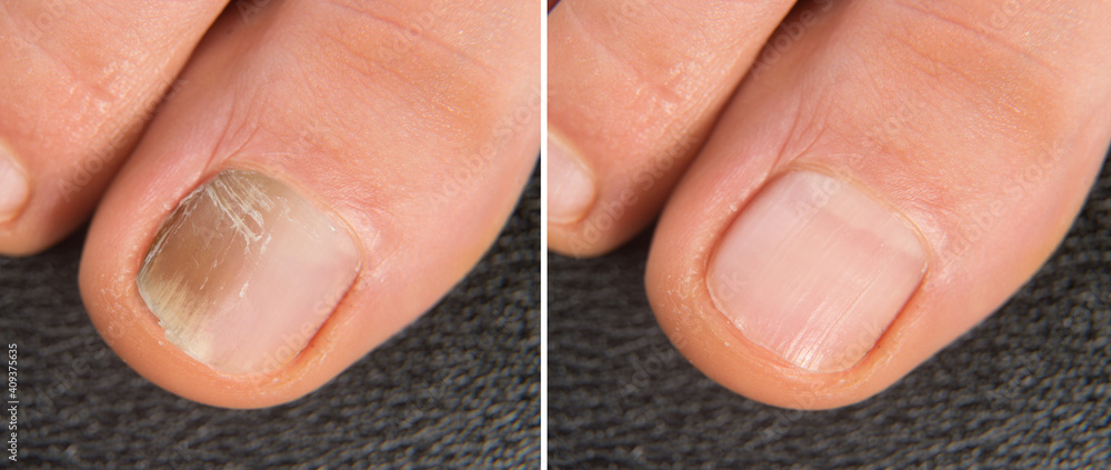 Big toe of a woman with nail affected by onychomycosis, close-up of ...