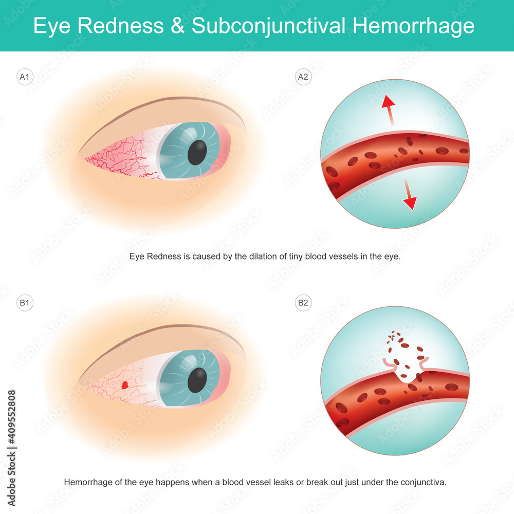 Eye Redness & Subconjunctival Haemorrhage. Eye Redness is caused by the ...