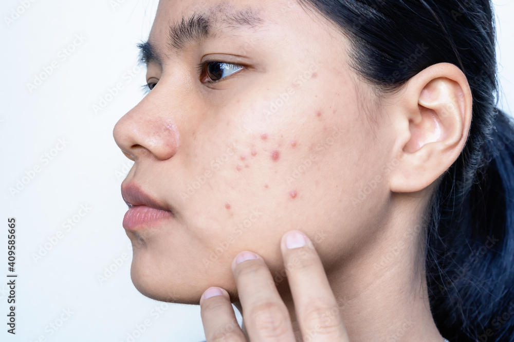 Close-up portrait of worried young Asian woman with acne problem on ...