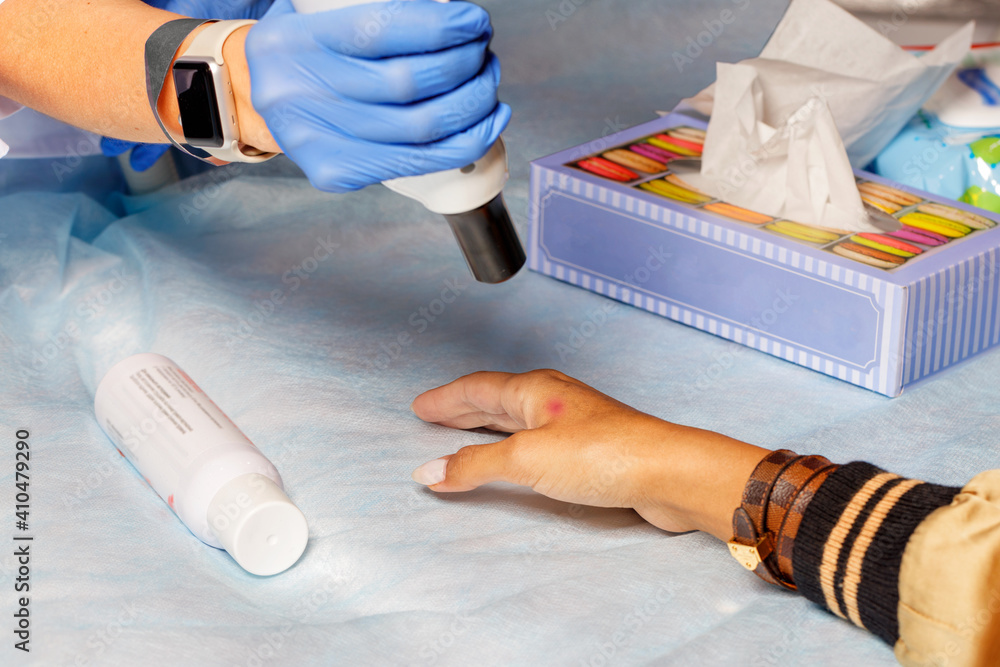 Doctor dermatologist cleans the skin on the patient's hand with a laser ...