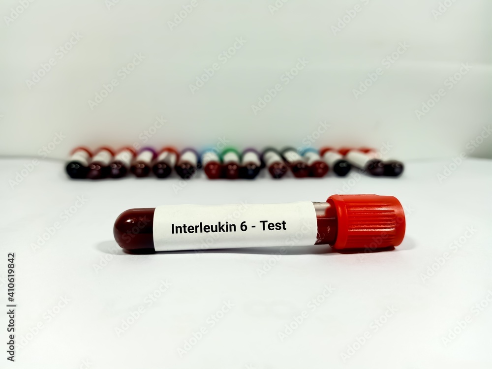 Blood sample for Interleukin 6 (IL-6) test, inflammatory cytokine, anti ...