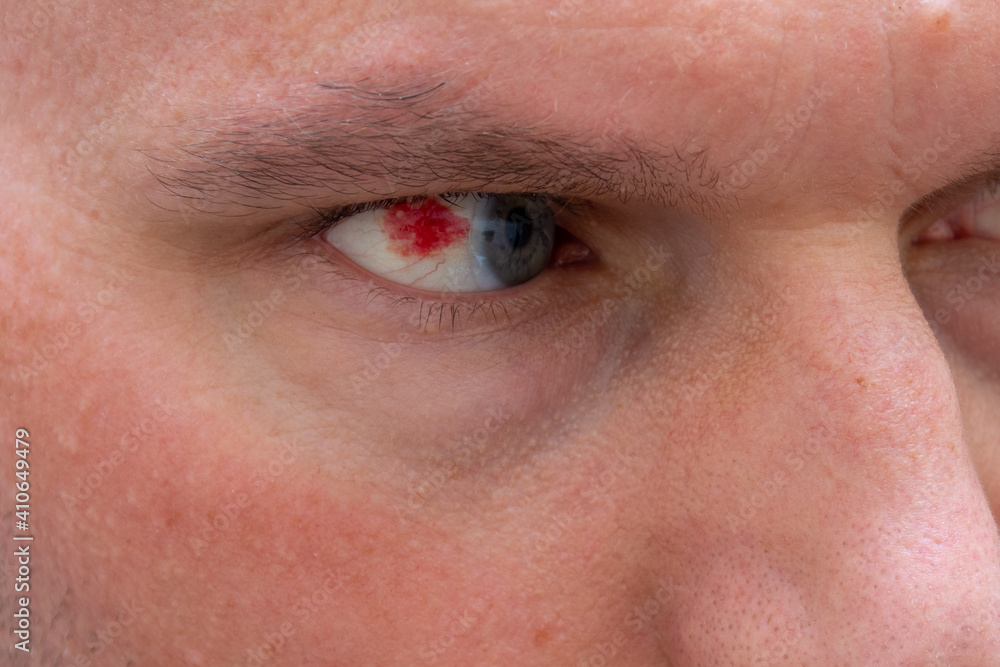 A close up of a subconjunctival hemorrhage red blood spot in a ...
