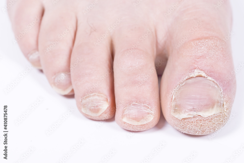 damaged toenails. Onychomycosis, nail psoriasis Stock Photo | Adobe Stock
