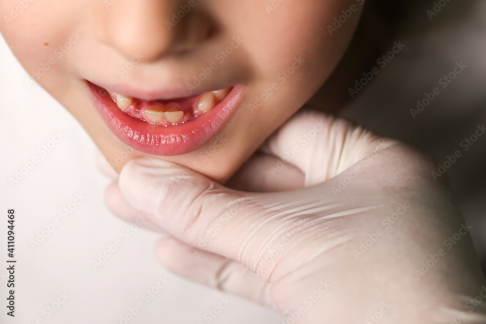 A dentist examines the baby teeth in the girl. The loss of milk teeth. The girl has no upper ...