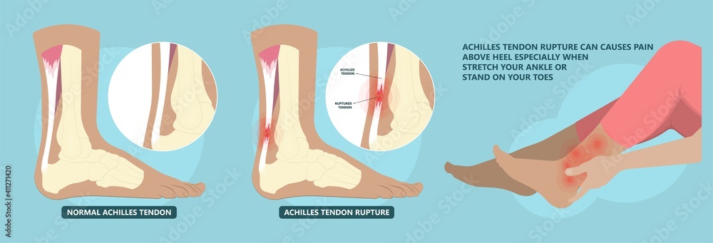 Achilles tendon rupture injury Feet calf test range of motion slight ...