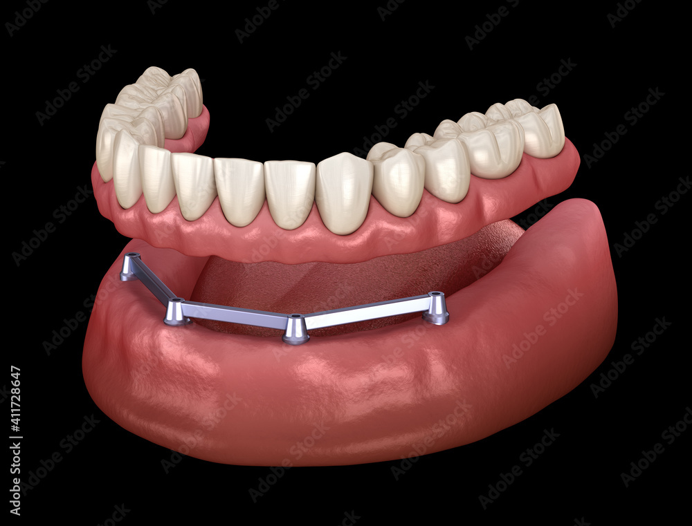 Mandibular prosthesis with gum All on 4 system supported by implants ...