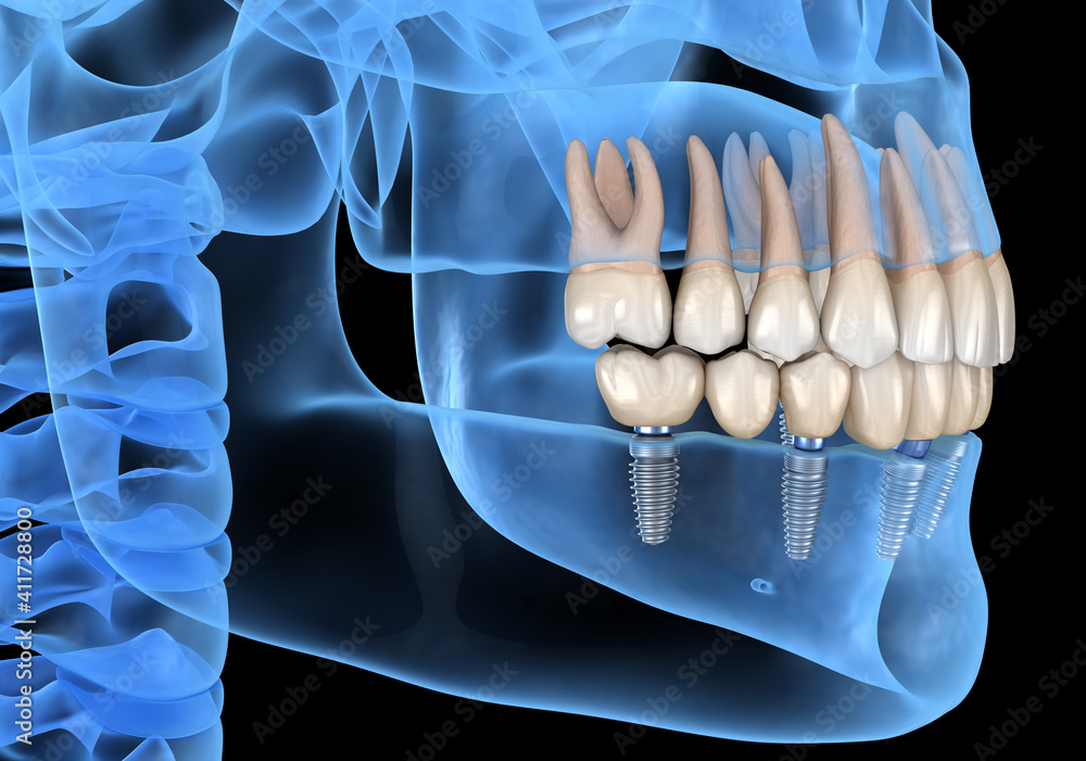 Teeth recovery with implant, x-ray view. Medically accurate 3D ...