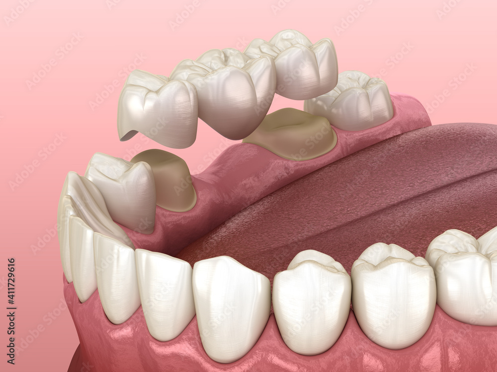 Dental bridge of 3 teeth over molar and premolar. Medically accurate 3D ...