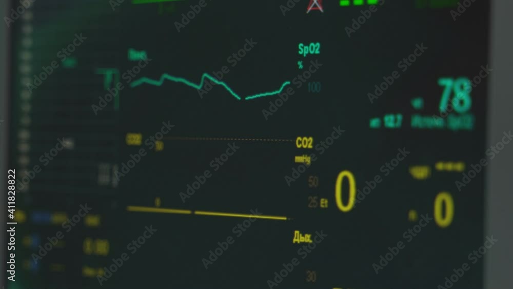 The monitor displays an ECG of the patient's vital signs, oxygen ...