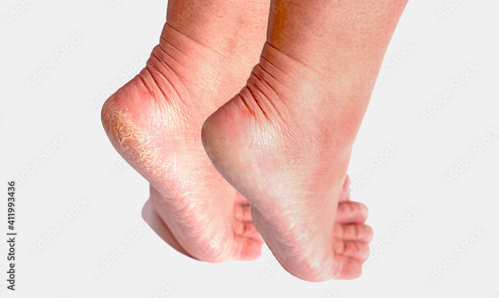 Image before and after treatment of dry heels cracks skin dehydrated ...