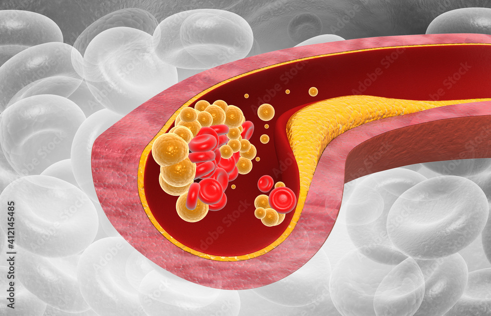 Blocked vein or clogged arteries. 3d illustration.. Stock Illustration ...