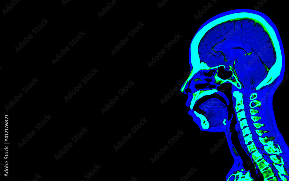 colorful of CT angiography of the brain or CTA brain Sagittal view ...