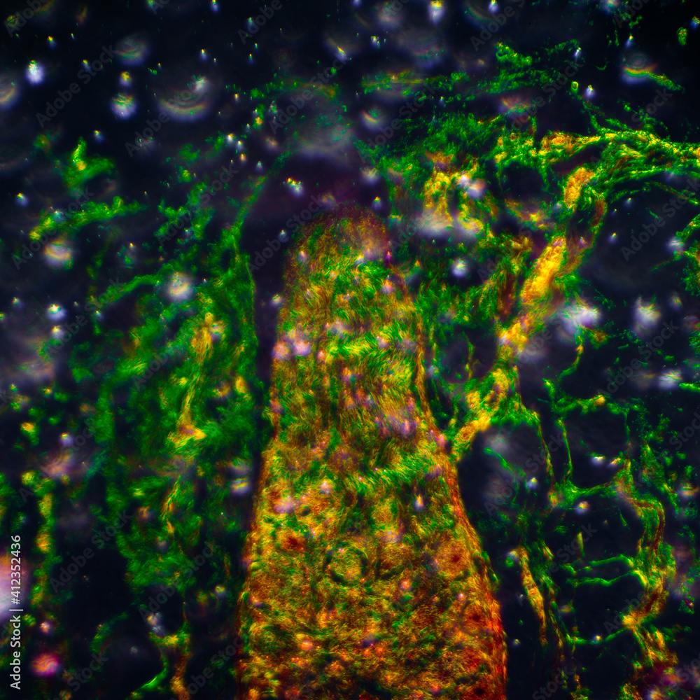 Squamous metaplasia of bronchial mucosa Stock Photo | Adobe Stock