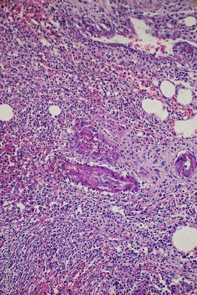 inflammatory cells of human Stock Photo | Adobe Stock