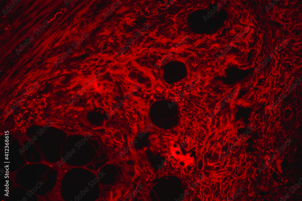 Suppurative inflammation of human appendix foto de Stock | Adobe Stock