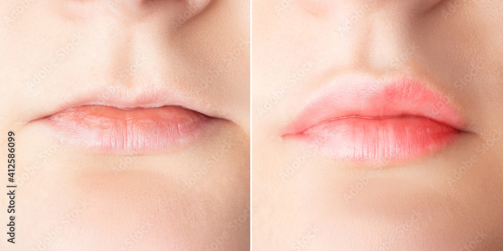 Lip augmentation before and after close up. Woman lips surgery, filler ...