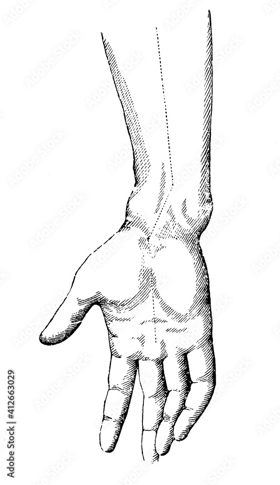 Buckling of the joint and hand due to a fracture of the lower part of ...