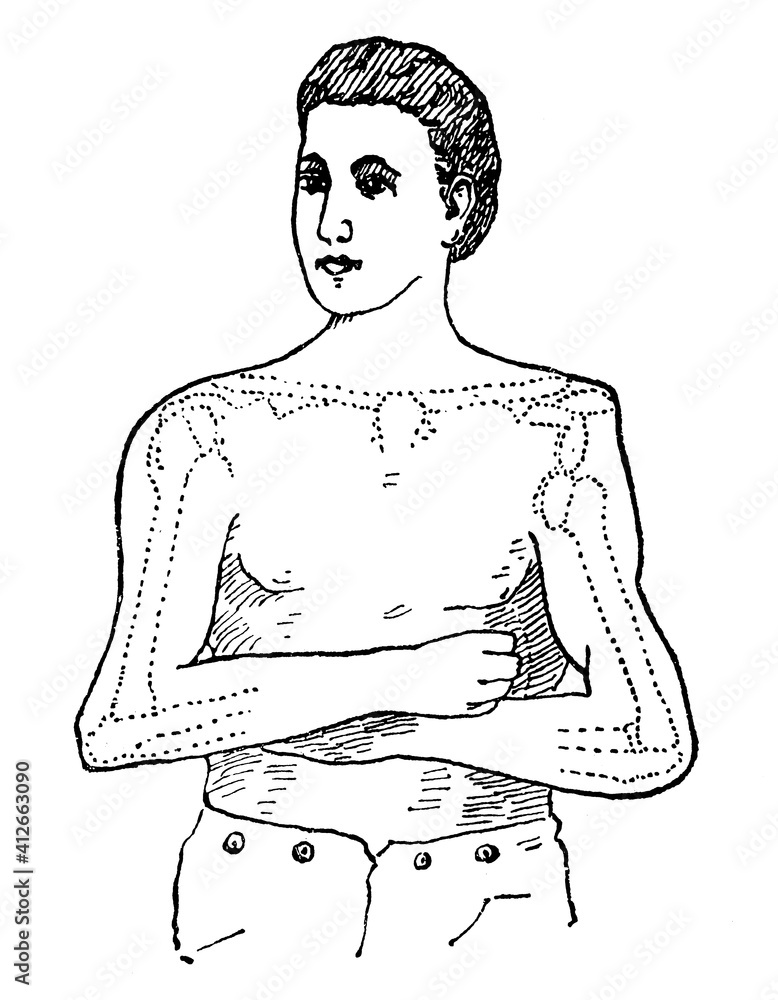 Schematic representation of the dislocation of the shoulder joint ...