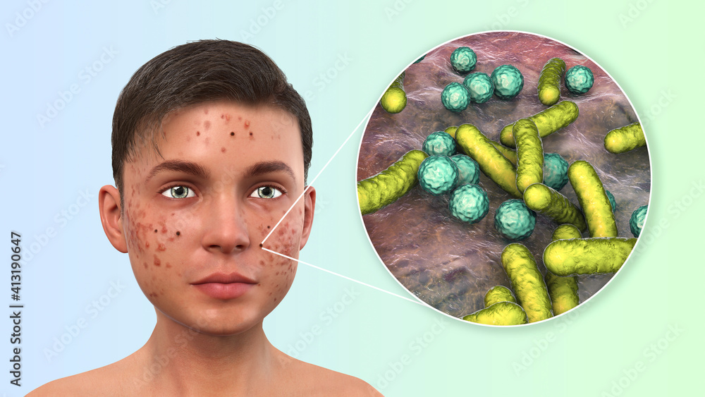 Acne, pimples, and closeup view of bacteria, the causative agents of ...