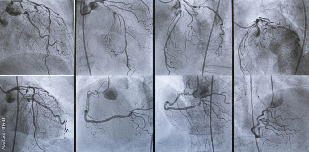 Coronary angiogram , medical x-ray for heart disease. Coronary artery ...