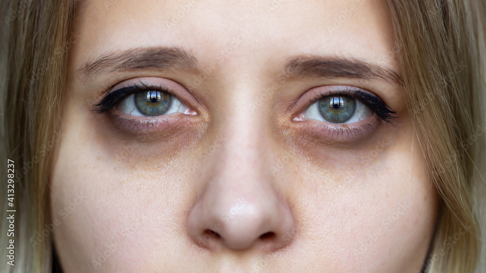 Cropped shot of a young female face. Green eyes with dark circles under ...