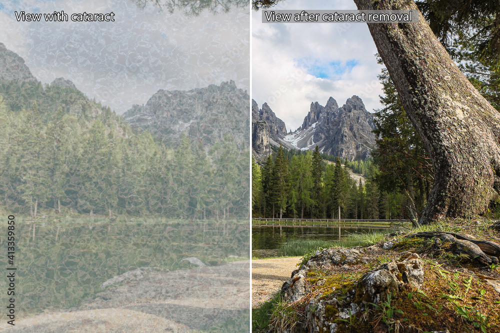 Cataracts Vision Simulator