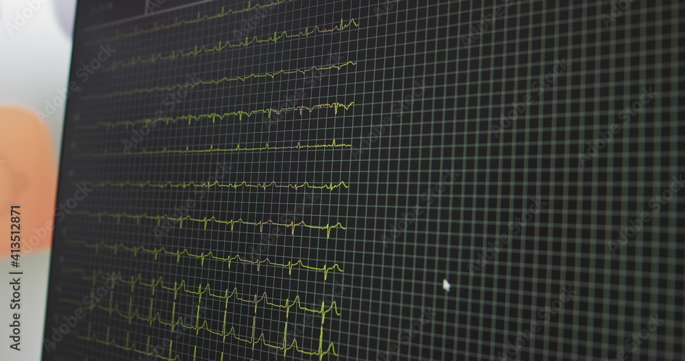 Heart rate monitor in hospital theater. Medical vital signs monitor ...