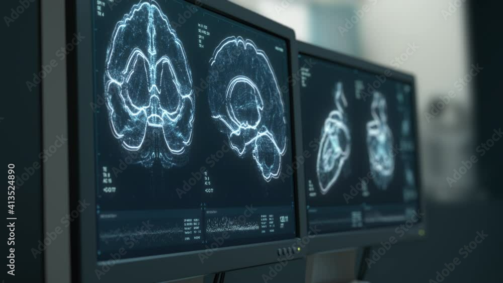 Heart and brain scanning data displayed on hospital monitors. Magnetic ...