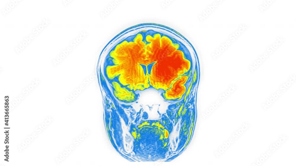 Computed medical tomography MRI upscaled scan of healthy young female ...