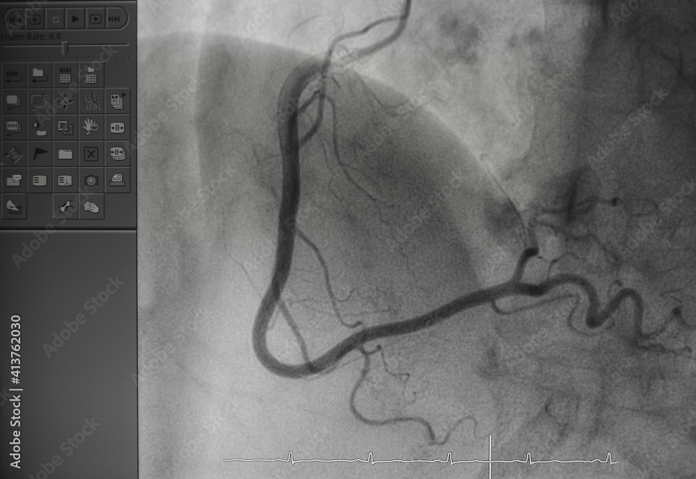 Coronary angiogram , medical x-ray for heart disease. Coronary artery ...