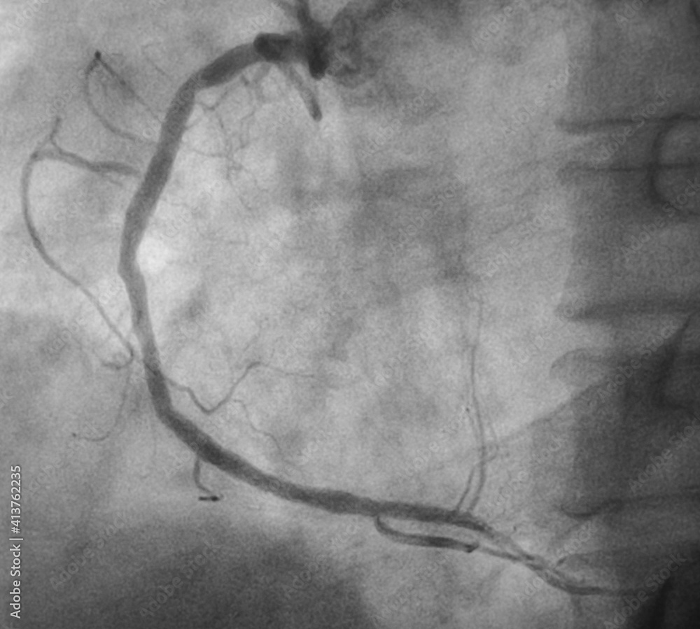 Coronary angiogram , medical x-ray for heart disease. Coronary artery ...