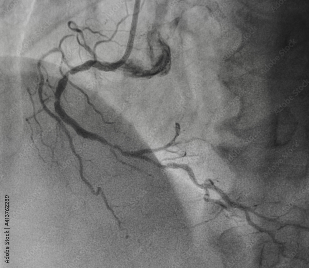 Coronary angiogram , medical x-ray for heart disease. Coronary artery ...