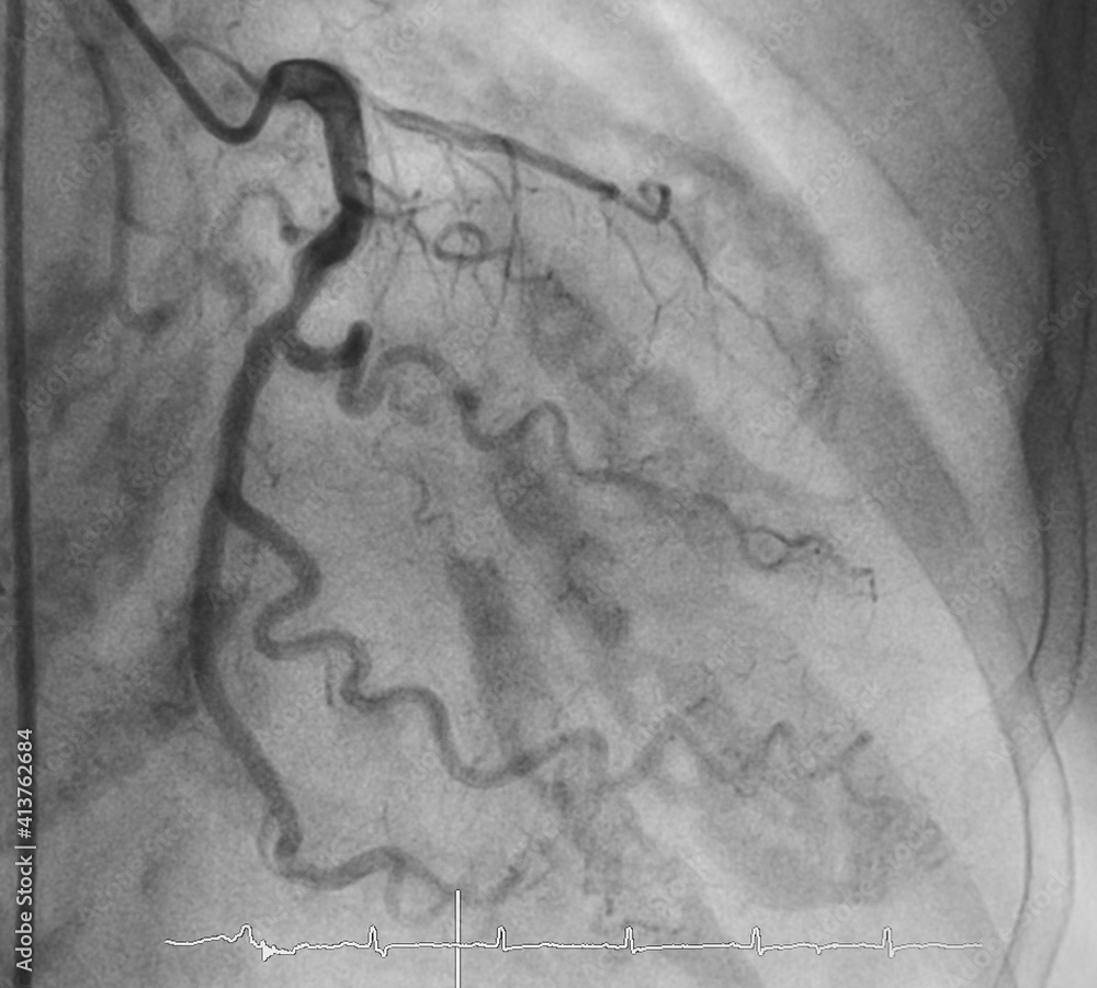 Coronary angiogram , medical x-ray for heart disease. Coronary artery ...
