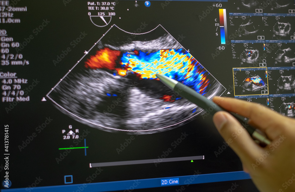 Echocardiography ultrasound Machine Doppler Of Aortic Stenosis Stock echocardiography-ultrasound-machine-doppler-of-aortic-stenosis-stock