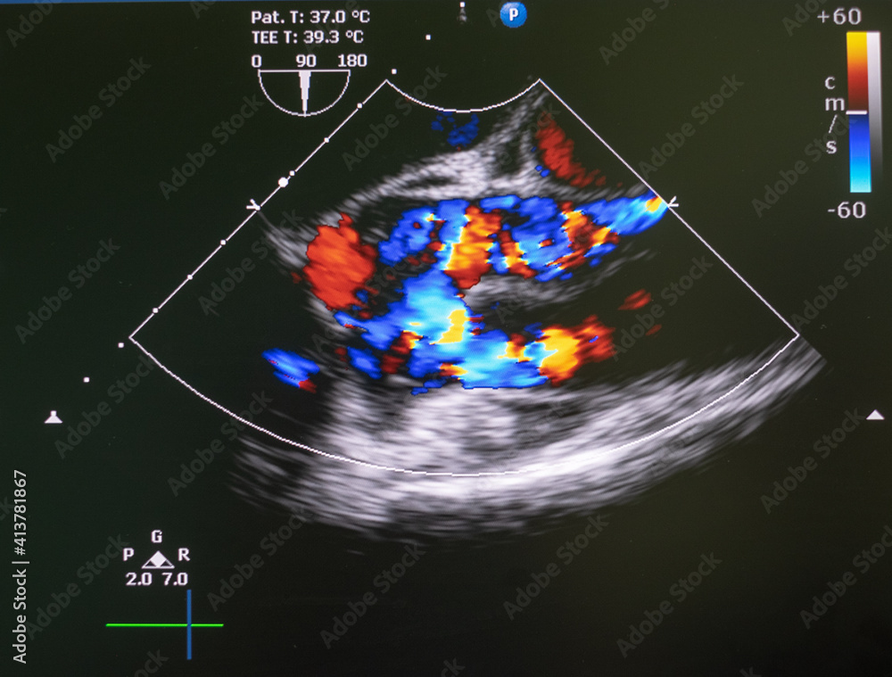 Echocardiography (ultrasound) machine. doppler of aortic stenosis Stock ...
