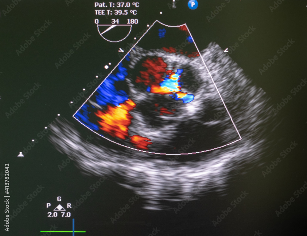 Foto de Echocardiography (ultrasound) machine. doppler of aortic ...