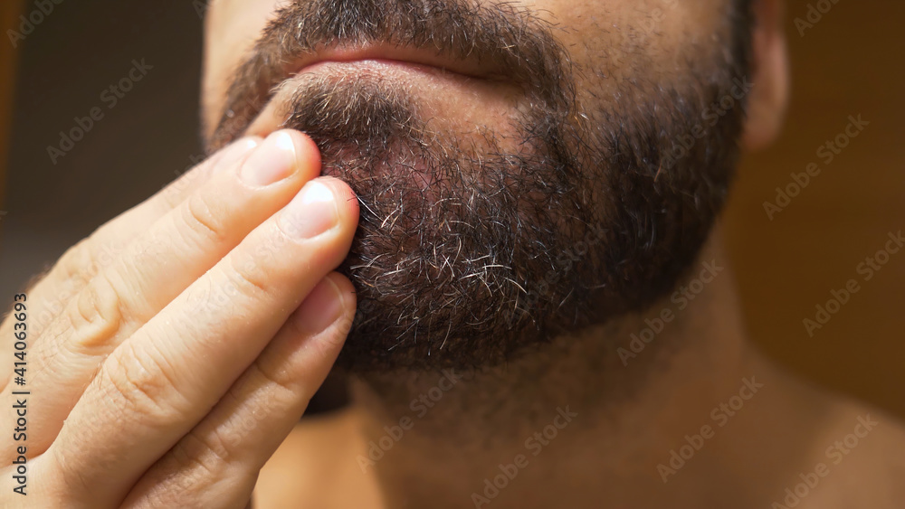 Detail of the man's chin with seborrheic dermatitis in the beard area ...