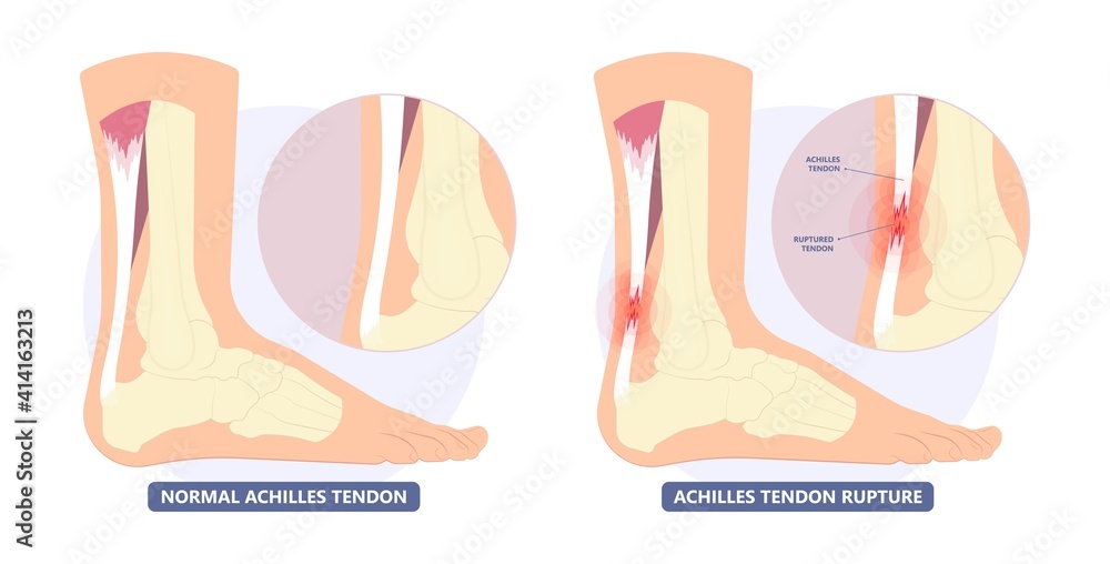 Achilles tendon rupture injury Feet calf test range of motion slight ...