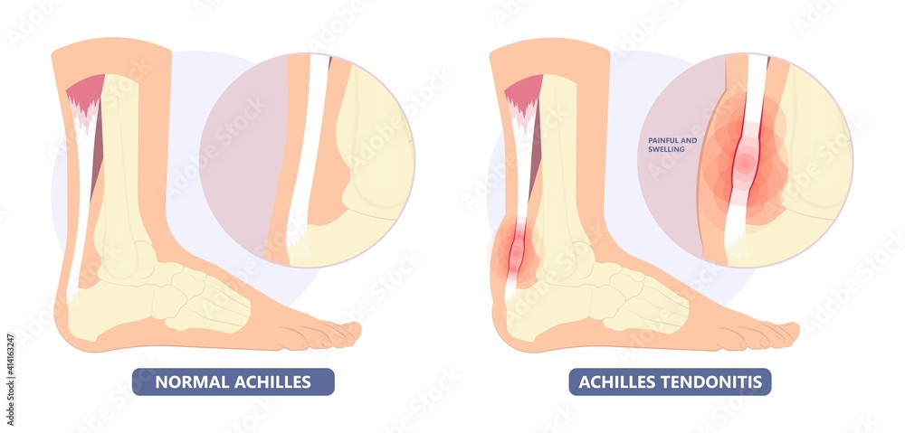 Achilles tendon rupture injury Feet calf test range of motion slight ...
