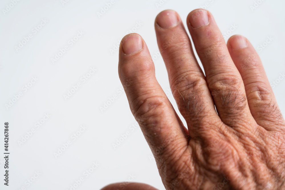 Old mans hand with bent and lumpy finger joints Stock Photo | Adobe Stock