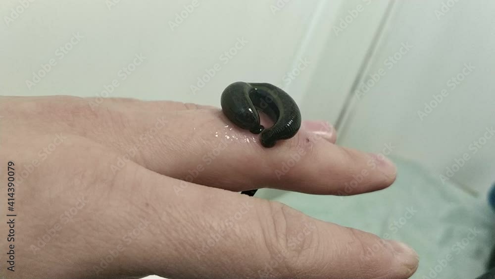 Treatment of a damaged finger joint with hirudotherapy. Leeches sucking ...