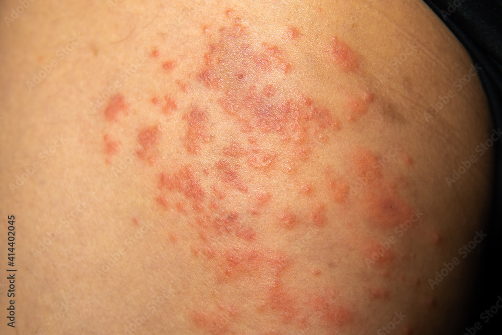 Men scratching legs suffering strong allergy skin itchy symptom ...