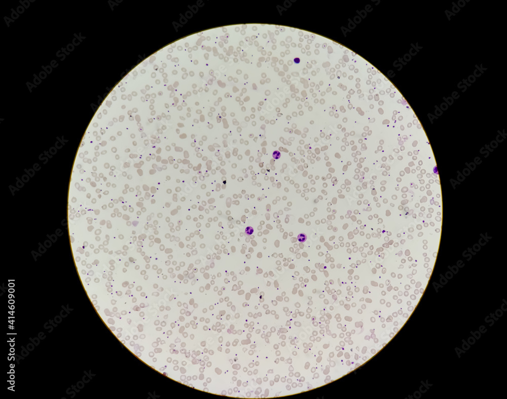 Microscopic blood film show low count of rbc wbc platelets called ...