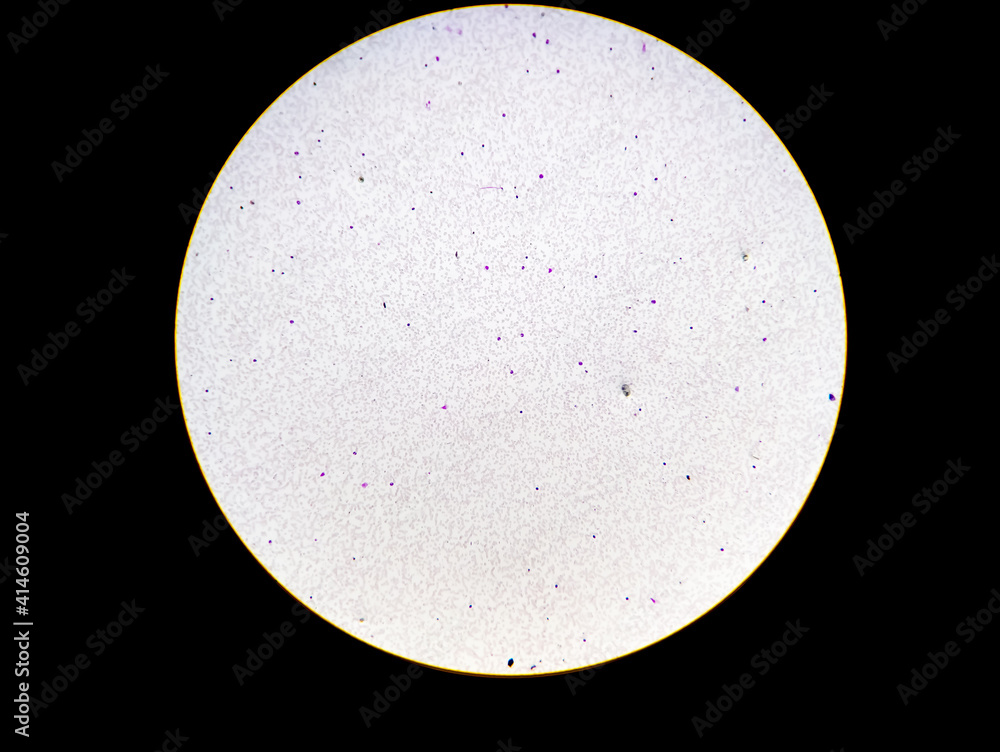 Microscopic 10x objective show leucocytosis image of blood film at ...