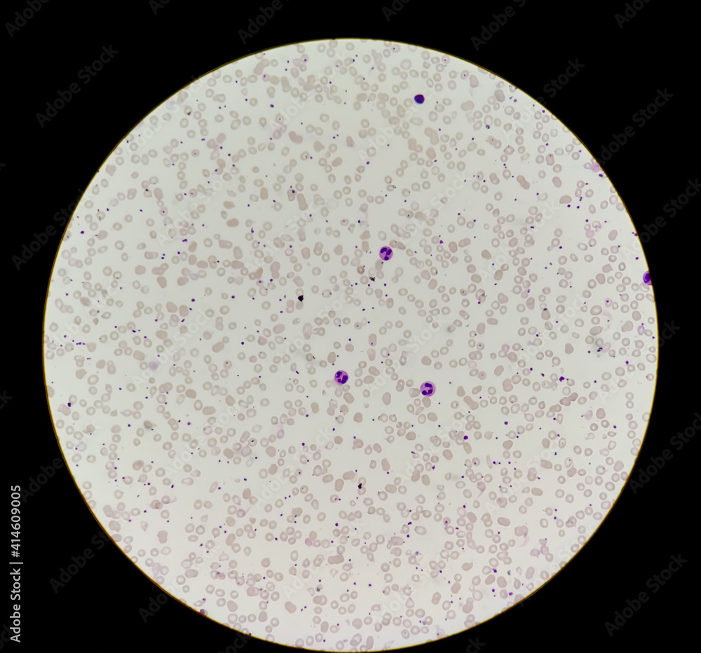 Microscopic blood film show low count of rbc wbc platelets called ...