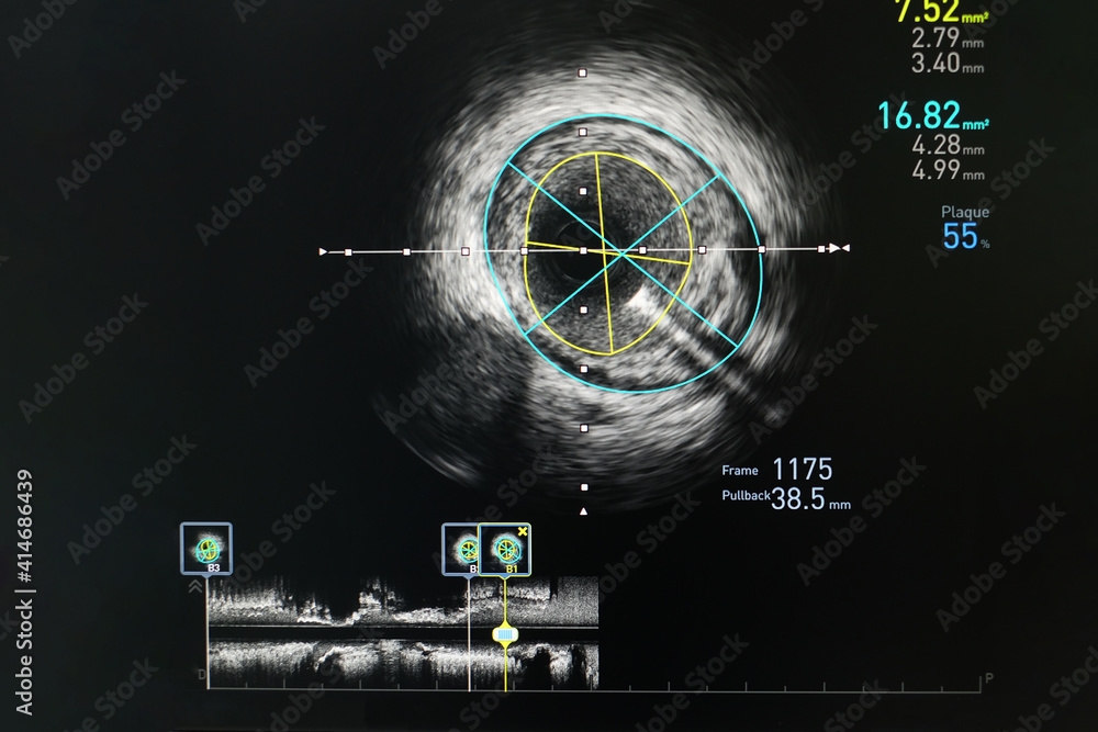 Intravascular ultrasound imaging (IVUS) at cardiac catheterization ...
