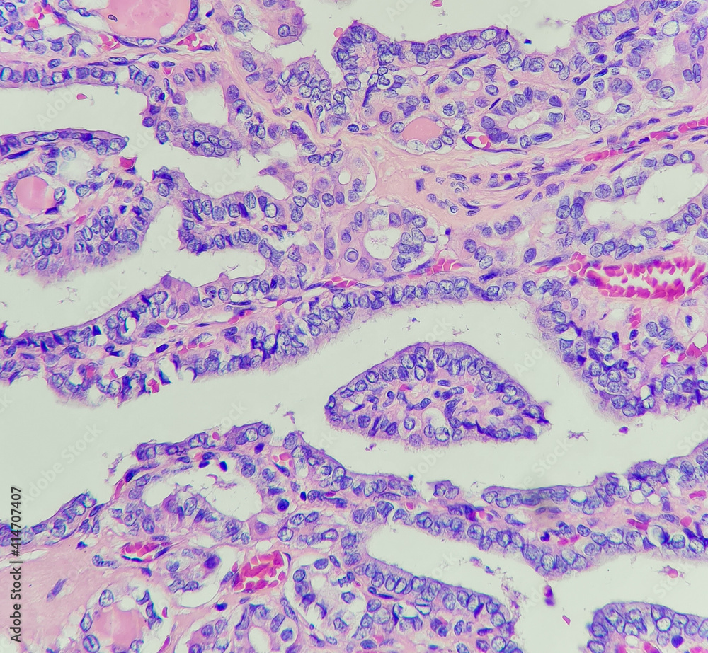 Photo of papillary thyroid carcinoma, showing intranuclear ...